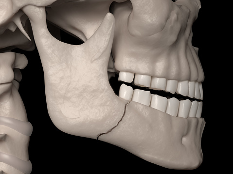 Popular jaw surgery technique challenged - Scimex
