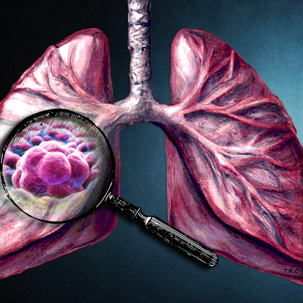 Tumour matrix profiling gives clues to progression of some lung cancers ...