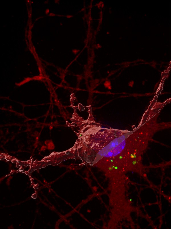 New discovery for how the brain ‘tangles’ in Alzheimer’s Disease - Scimex